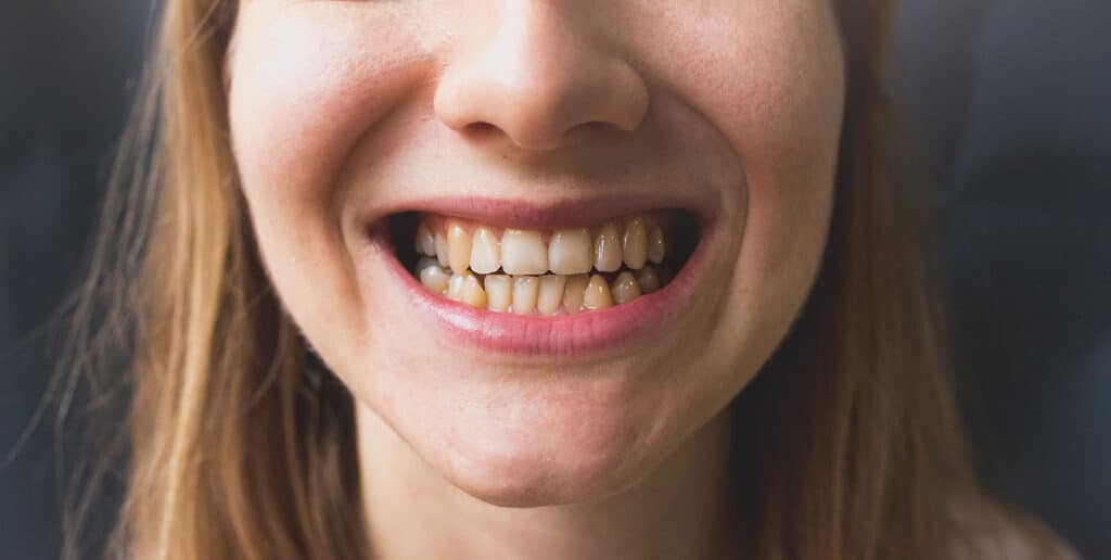 Coke Jaw, Mouth, and Nose: Dangerous Side Effects of Cocaine Use - Long ...