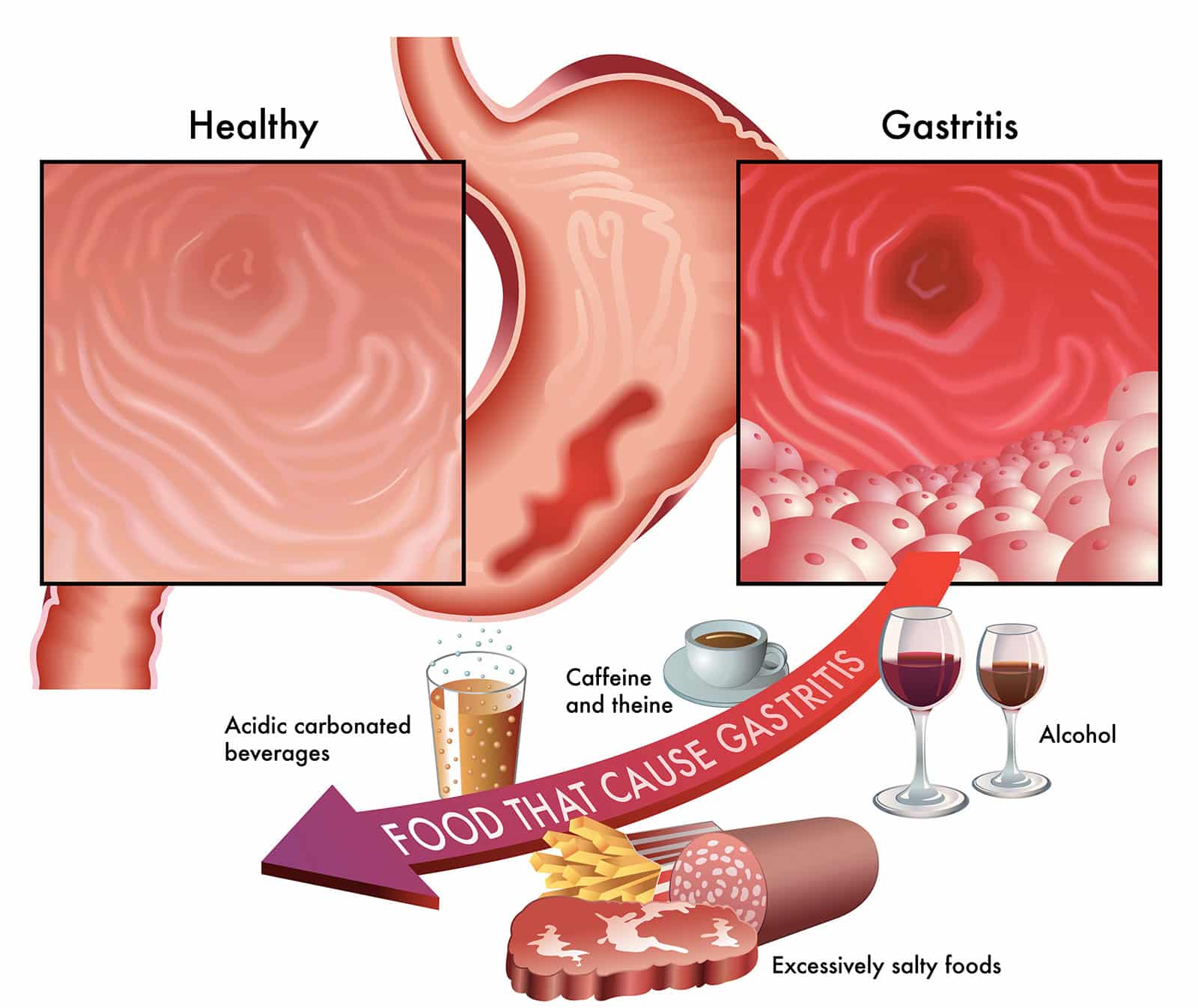 Alcoholic Gastritis - Recovery Time, Diagnosis, Treatment, and ...